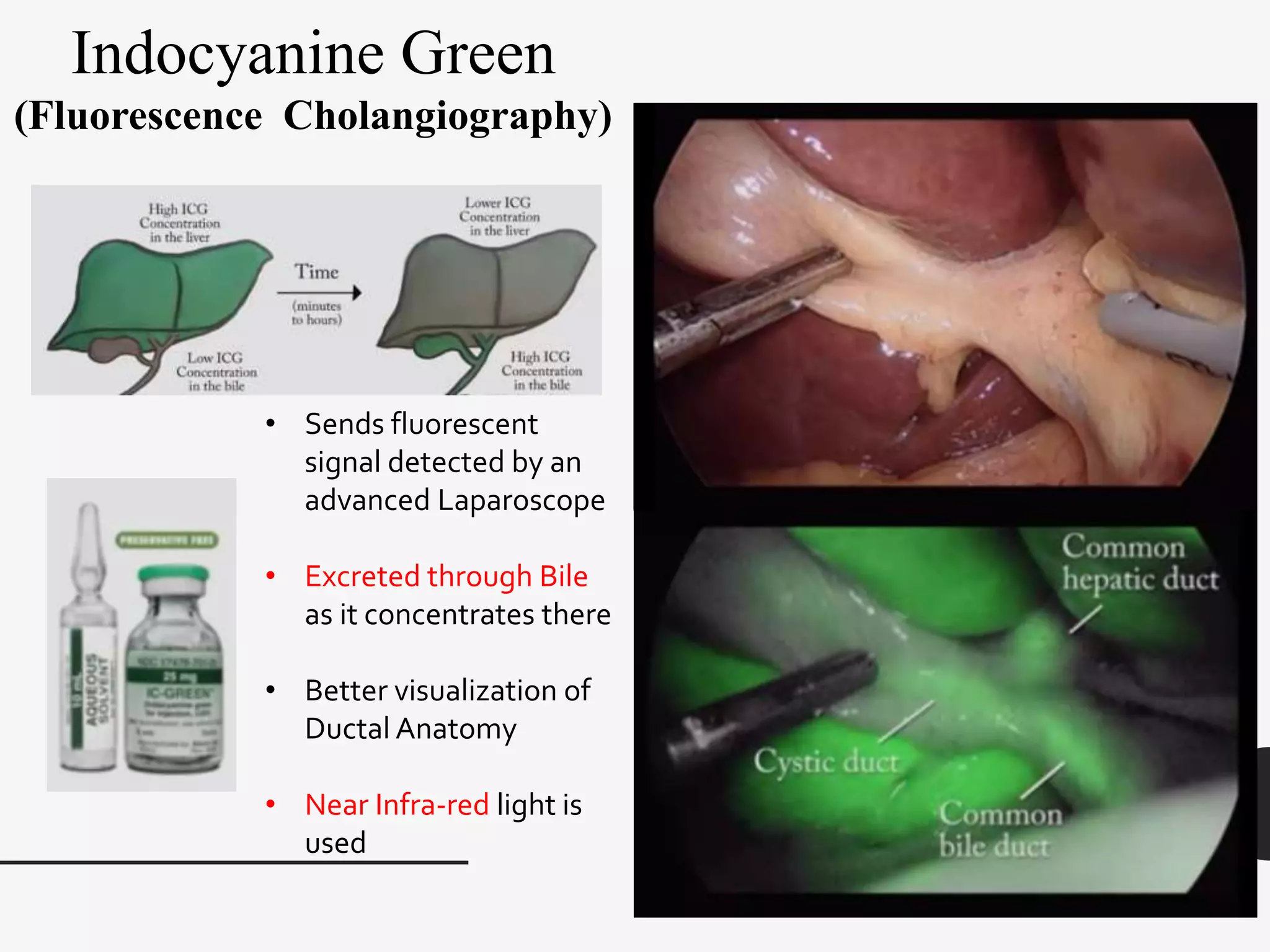 Laparoscopic Cholecystectomy | PPTX