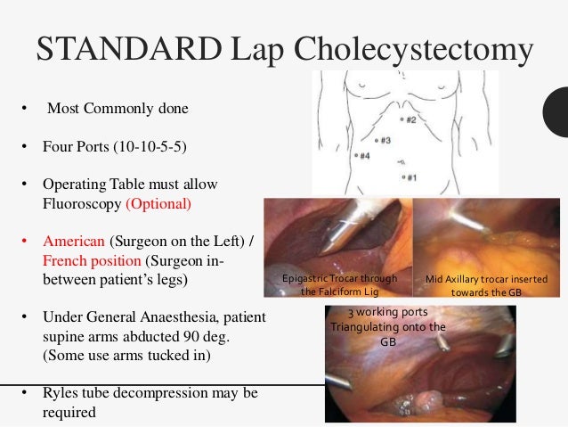 Laparoscopic Cholecystectomy Youtube