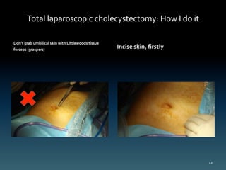 Laparoscopic cholecystectomy, 2019, by R. Lunevicius | PDF