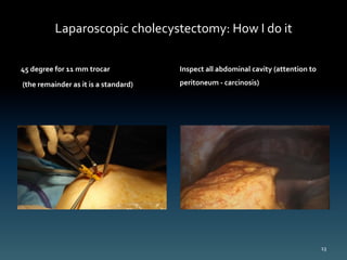 Laparoscopic cholecystectomy, 2019, by R. Lunevicius | PDF