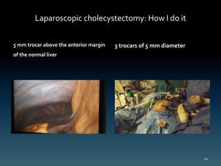 Laparoscopic cholecystectomy, 2019, by R. Lunevicius | PDF
