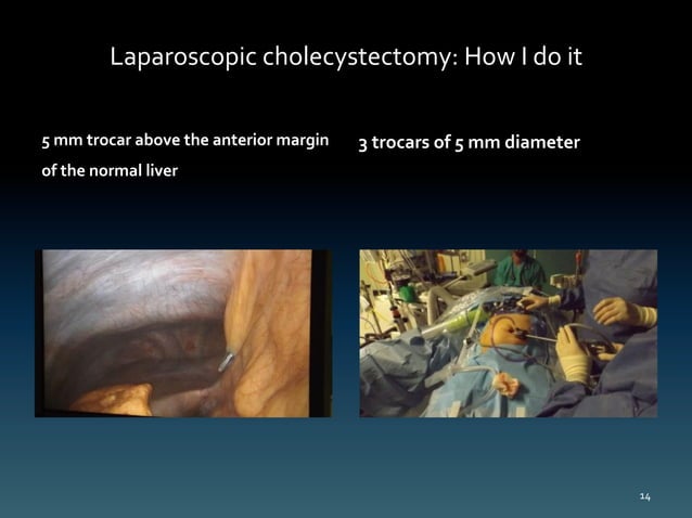 Laparoscopic cholecystectomy, 2019, by R. Lunevicius | PDF