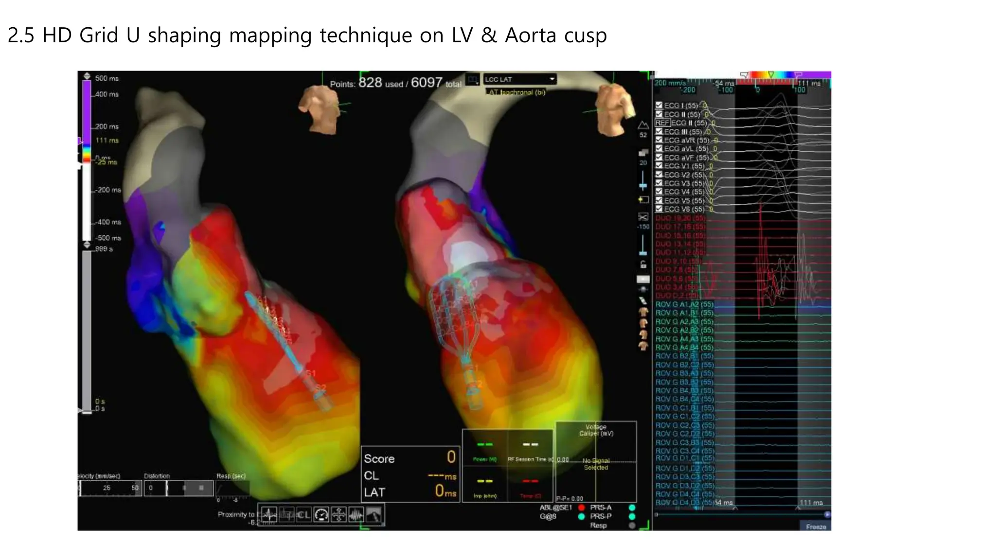 LCC PVC 자료_Abbott 나상규.pptx