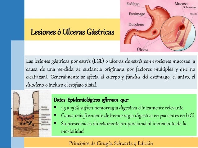 Úlcera de Curling y de Cushing