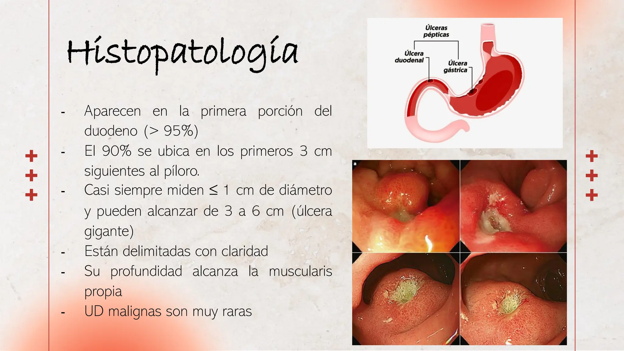 Úlcera duodenal, gastroenterología, aparato digestivo | PDF