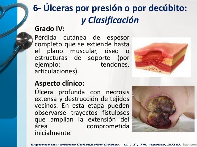 Úlceras por decúbito. Antonia Concepción Ovelar