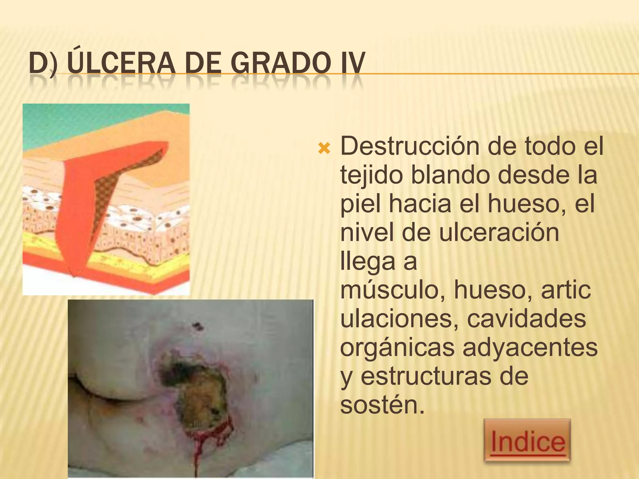 úLceras por presión | PPT