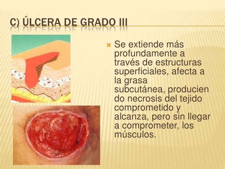 Ulceras por presión