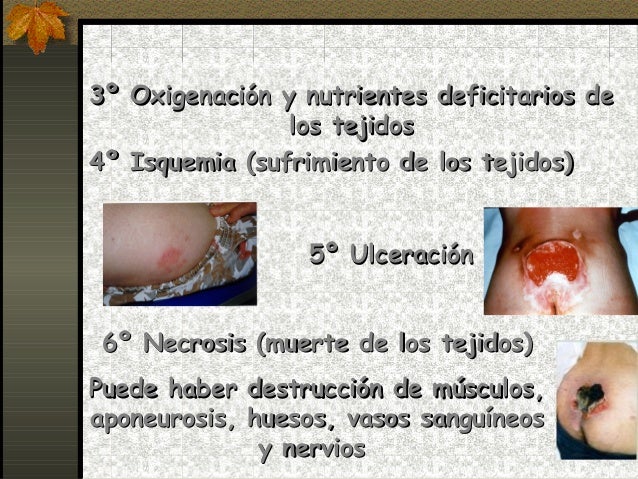 Úlceras por presión