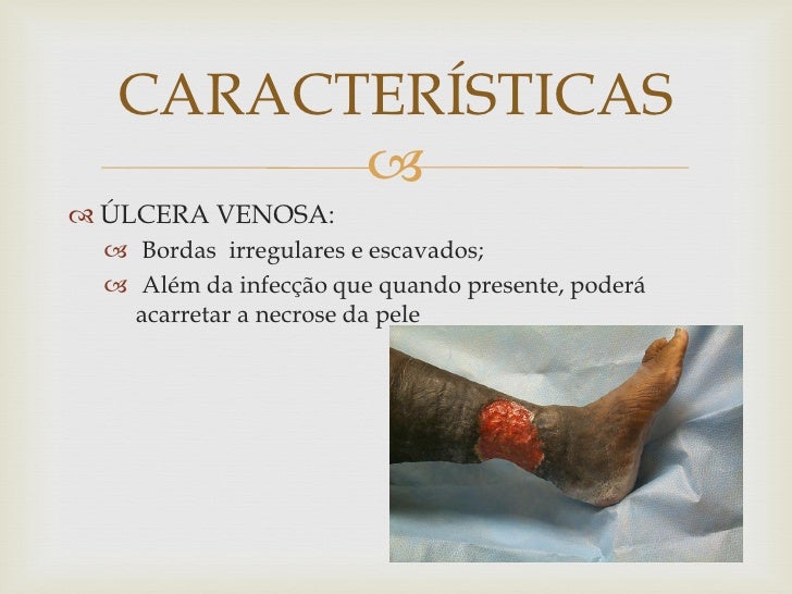 úLceras vasculogênicas