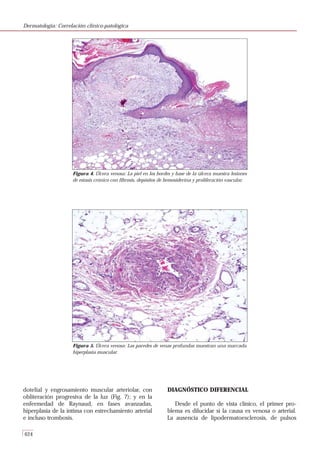 úLceras venosas y arteriales | PDF