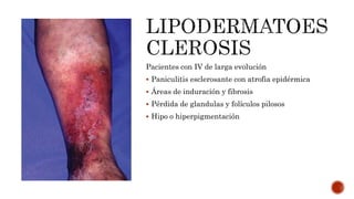 úLcera venosa | PPTX