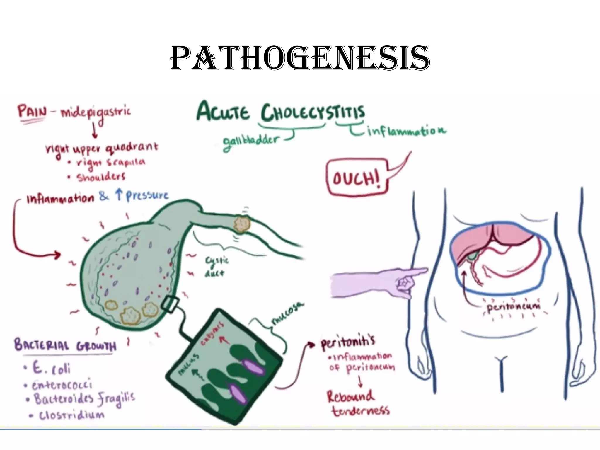 L cholecystitis students | PPT