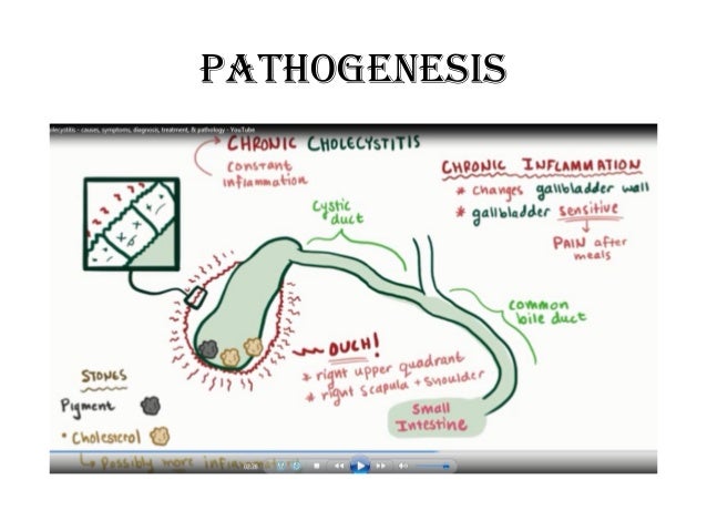 L cholecystitis students