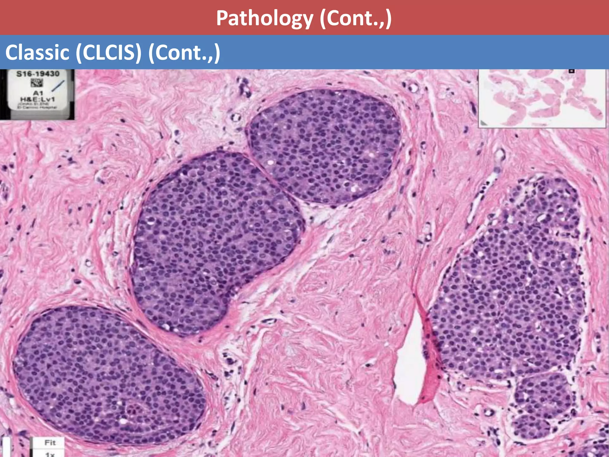 Lobular Carcinoma In Situ (LCIS) | PPTX