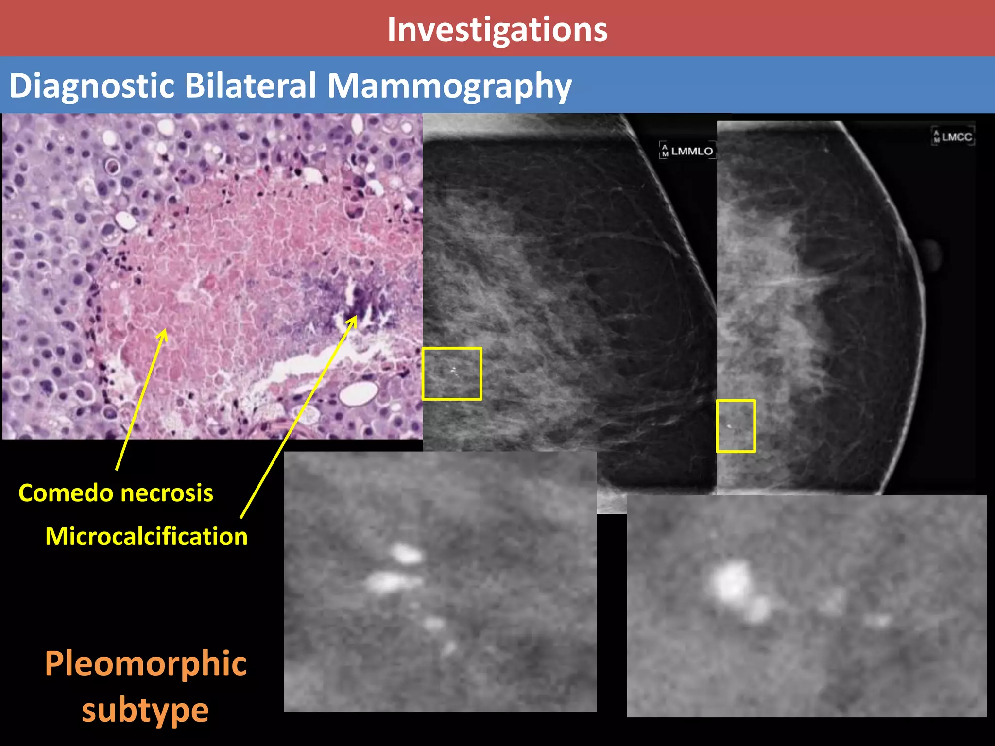 Lobular Carcinoma In Situ (LCIS) | PPTX