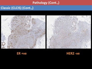 Lobular Carcinoma In Situ (LCIS) | PPTX