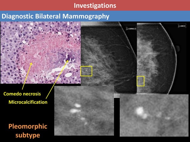 Lobular Carcinoma In Situ (LCIS) | PPTX