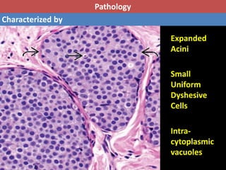 Lobular Carcinoma In Situ (LCIS) | PPTX