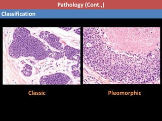 Lobular Carcinoma In Situ (LCIS) | PPTX