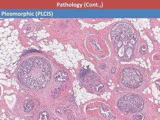 Lobular Carcinoma In Situ (LCIS) | PPTX