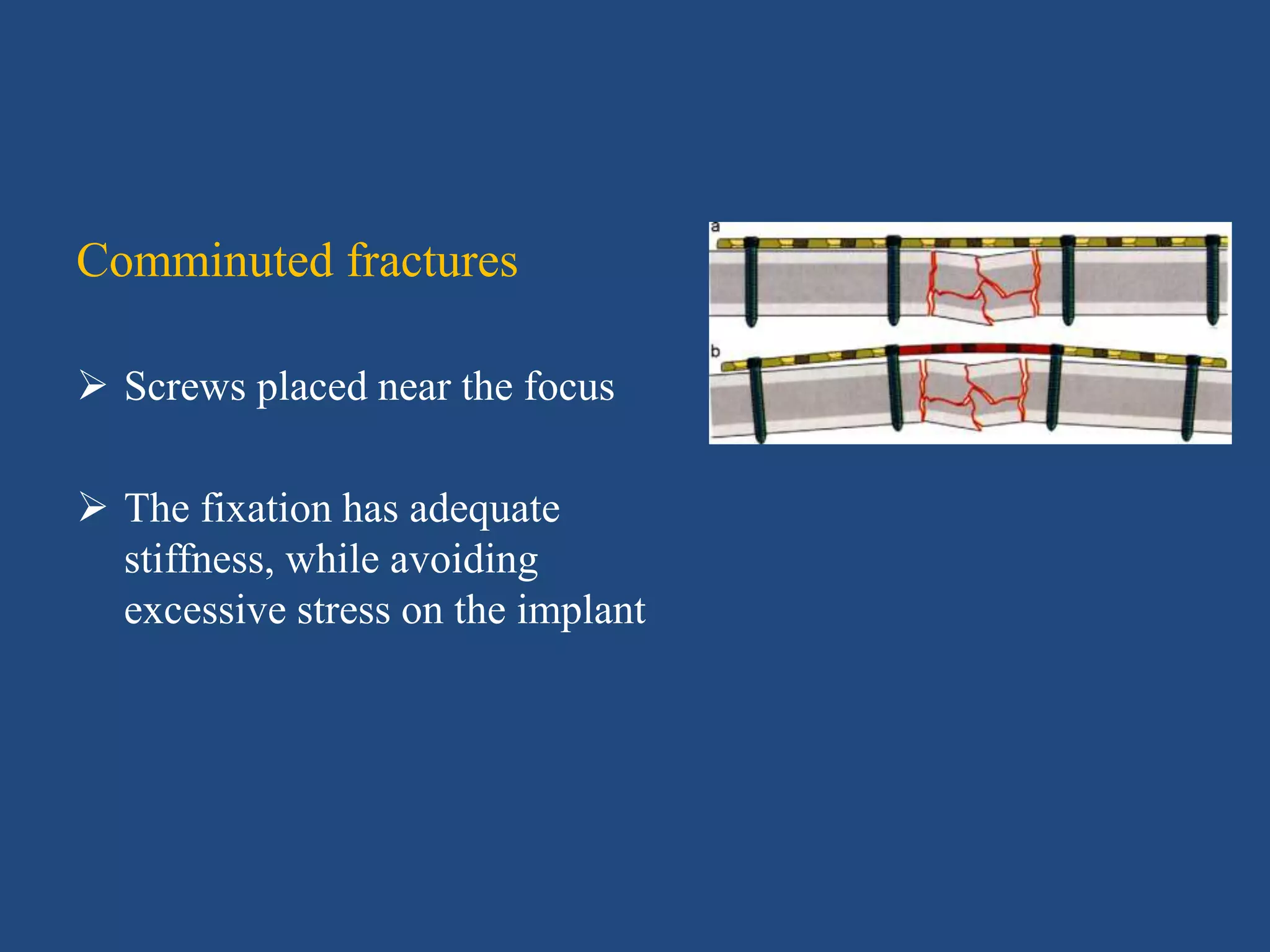 Lcp configuration, indication, advantages and biomechanics | PPTX