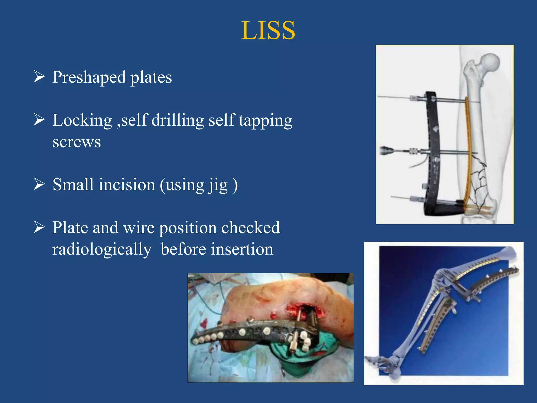 Lcp configuration, indication, advantages and biomechanics | PPTX