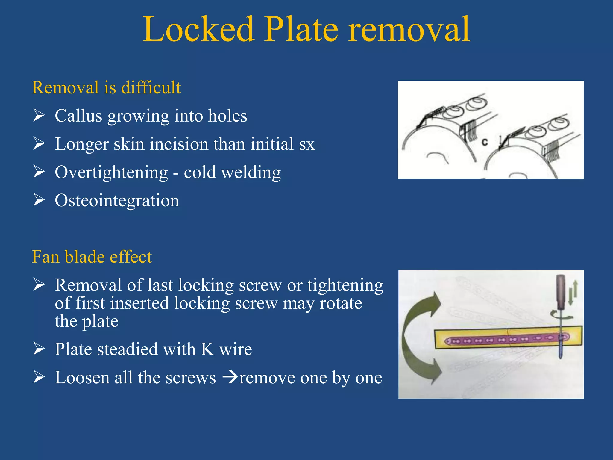 Lcp configuration, indication, advantages and biomechanics | PPTX