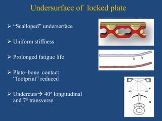 Lcp configuration, indication, advantages and biomechanics | PPTX