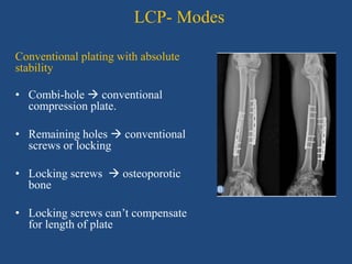 Lcp configuration, indication, advantages and biomechanics | PPT