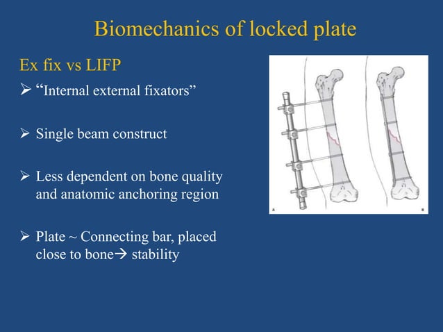 Lcp configuration, indication, advantages and biomechanics | PPTX