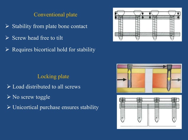Lcp configuration, indication, advantages and biomechanics | PPTX