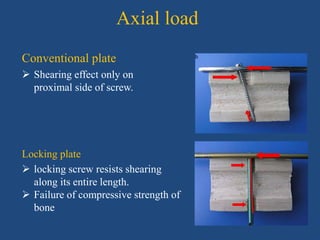 Lcp configuration, indication, advantages and biomechanics | PPT