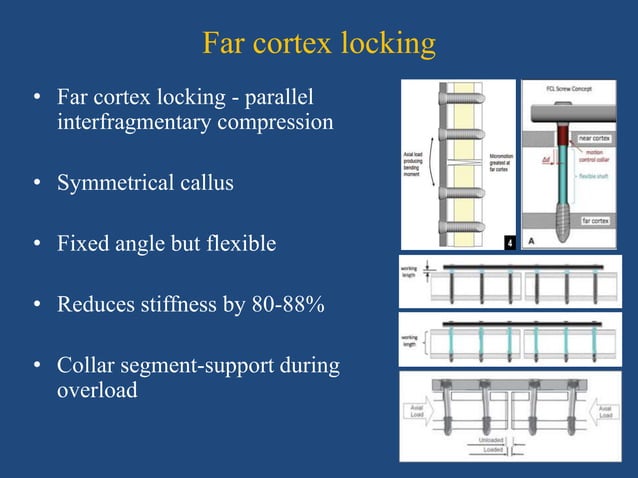 Lcp configuration, indication, advantages and biomechanics | PPTX
