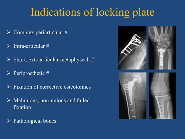 Lcp configuration, indication, advantages and biomechanics | PPTX