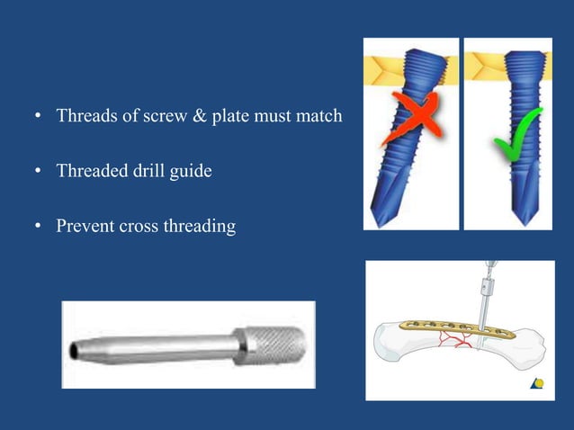 Lcp configuration, indication, advantages and biomechanics | PPTX