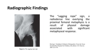 LCPD.pptx | Bone and Joint Conditions | Diseases and Conditions