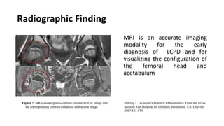 LCPD.pptx | Bone and Joint Conditions | Diseases and Conditions