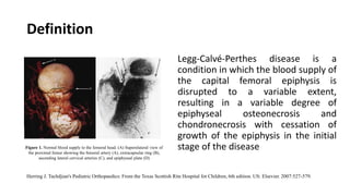 LCPD.pptx | Bone and Joint Conditions | Diseases and Conditions