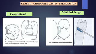 Class I , II Composites Cavity preparations | PPTX