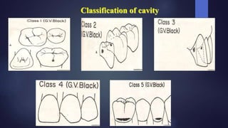 Class I , II Composites Cavity preparations | PPTX