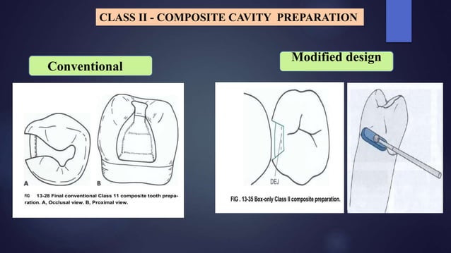 Class I , II Composites Cavity preparations | PPT