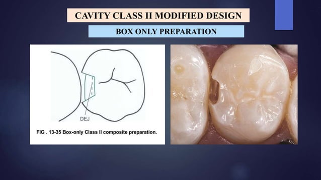Class I , II Composites Cavity preparations | PPT