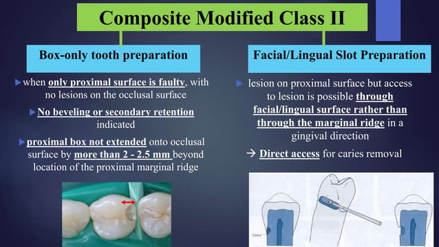 Class I Ii Composites Cavity Preparations Ppt