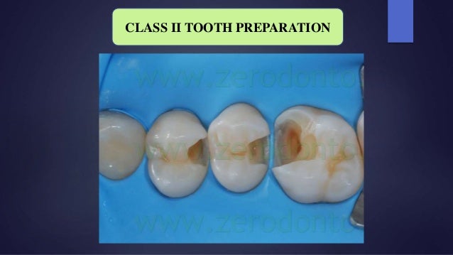 Class I , II Composites Cavity preparations