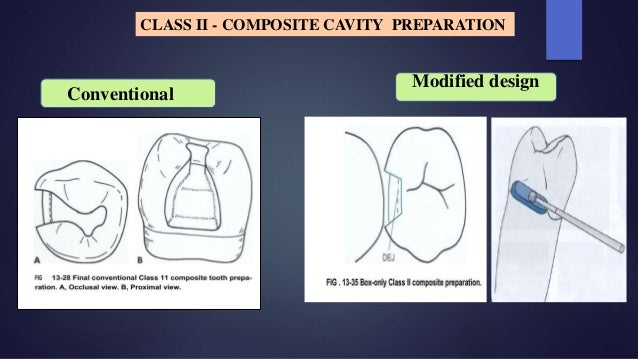 Class I , II Composites Cavity preparations