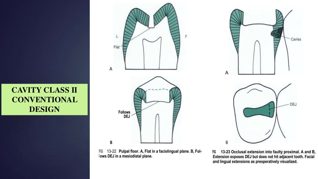 Class I Ii Composites Cavity Preparations