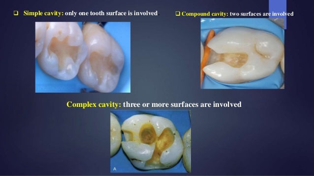 Class I , II Composites Cavity preparations