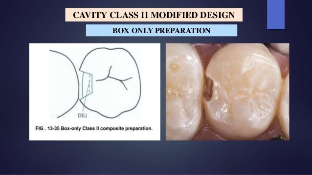Class I , II Composites Cavity preparations