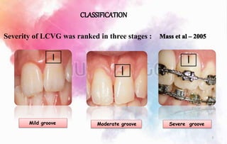 LABIOCERVICAL VERTICAL GROOVE | PPTX
